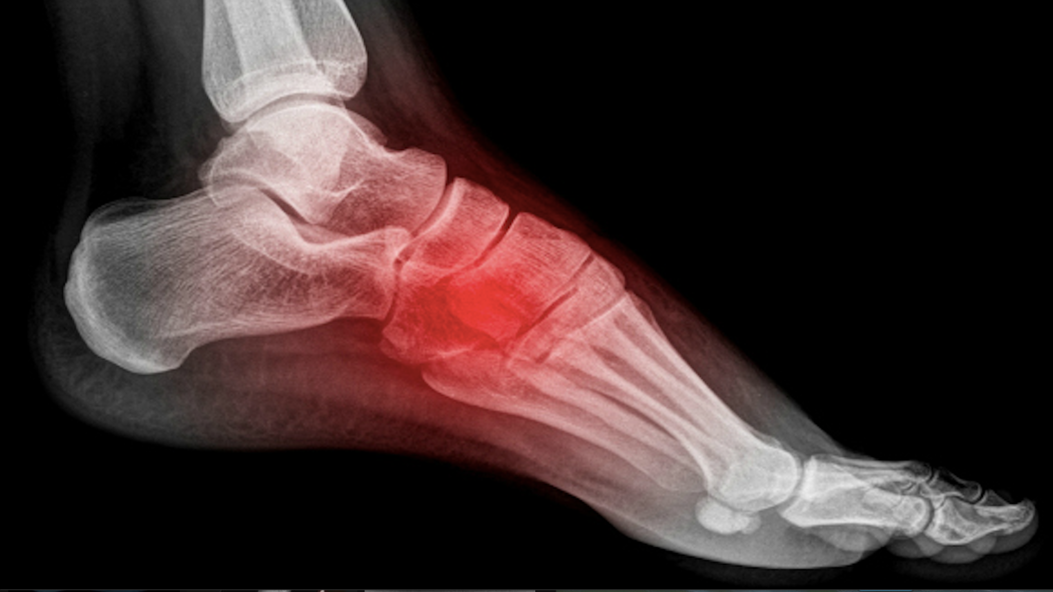 Symptomes Fracture De Fatigue – Soigner Une Fracture De Fatigue – NOSGB